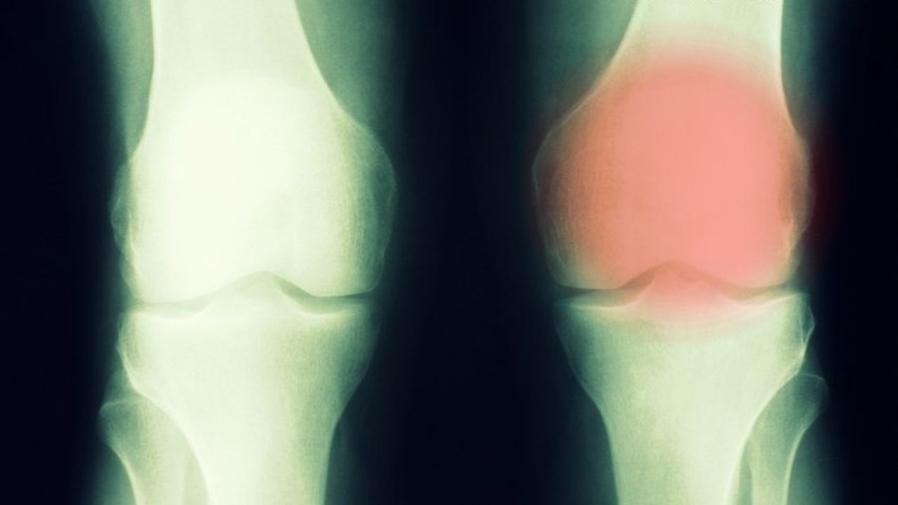 Advaxis gets fast-track status for bone cancer drug | NASDAQ:ADXS