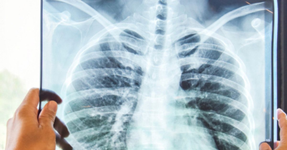 Recce Pharmaceuticals makes breakthrough in lung infection treatment ...