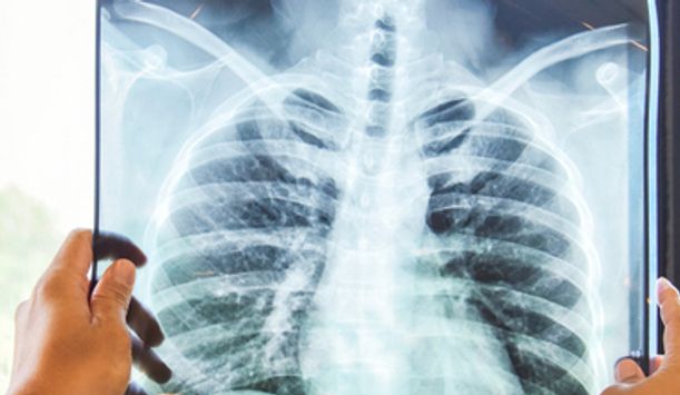 Recce Pharmaceuticals makes breakthrough in lung infection treatment ...