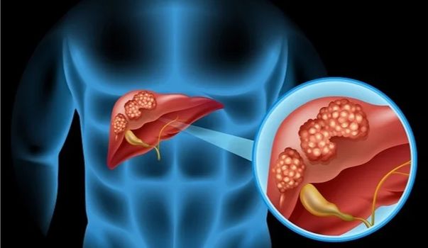 Imugene plans Phase 1 VAXINIA MAST trial expansion to target bile duct ...