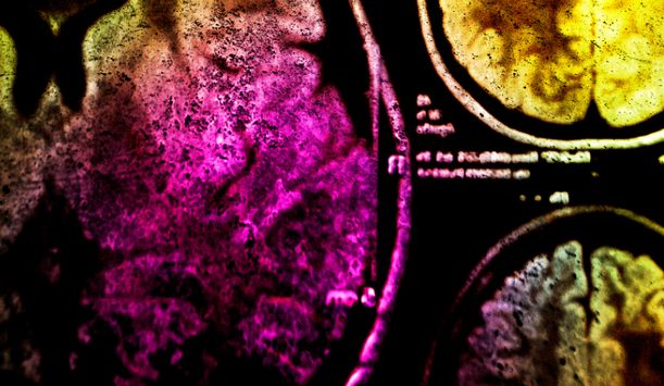 IXICO lands £500k phase II Huntington's contract | LSE:IXI, OTC:PHYOF