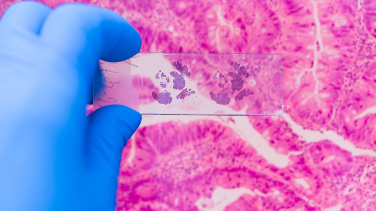 BCAL Diagnostics advances early cancer blood tests towards 2026 launch ...