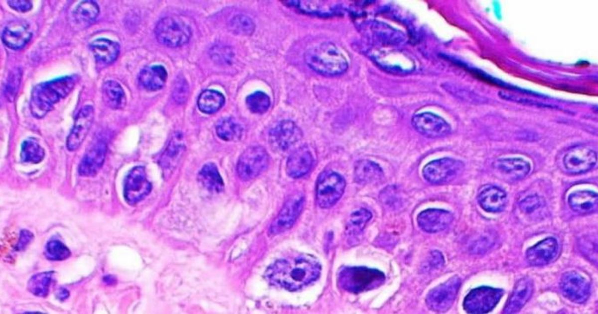 Medicus Pharma seeks orphan drug status for SkinJect in rare skin ...