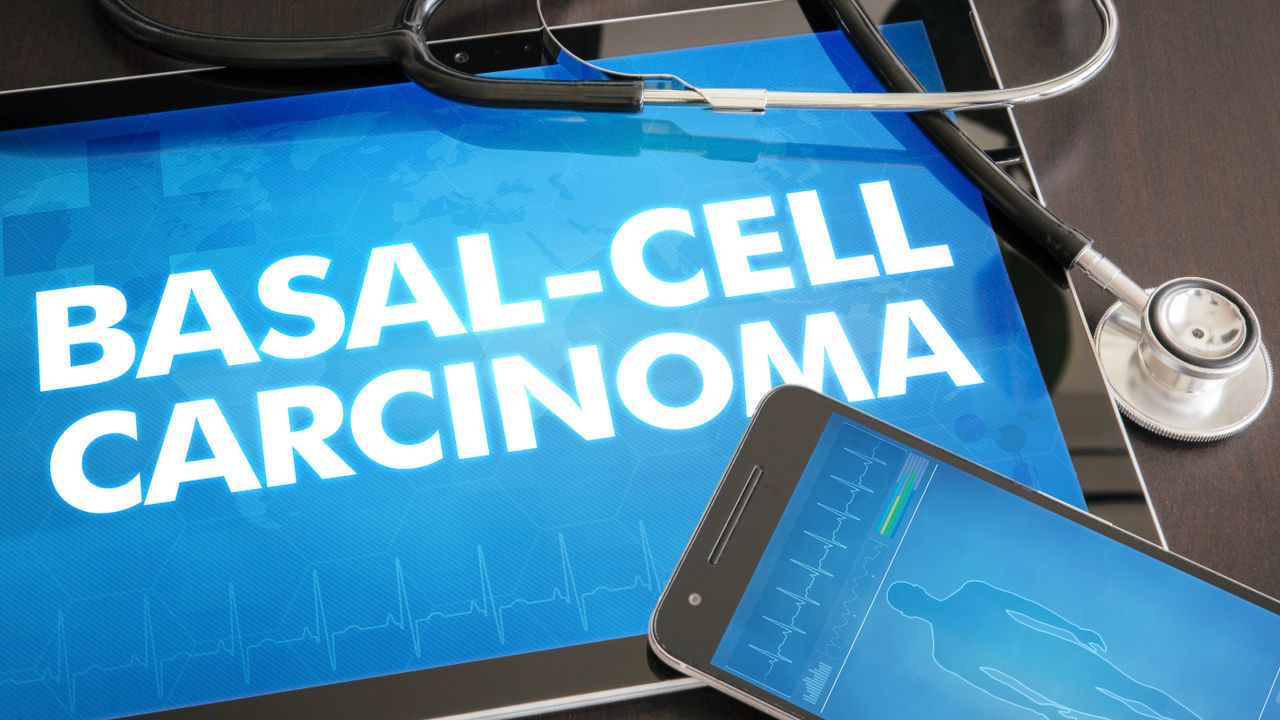 Medicus Pharma reports positive Phase 2 results for microneedle ...