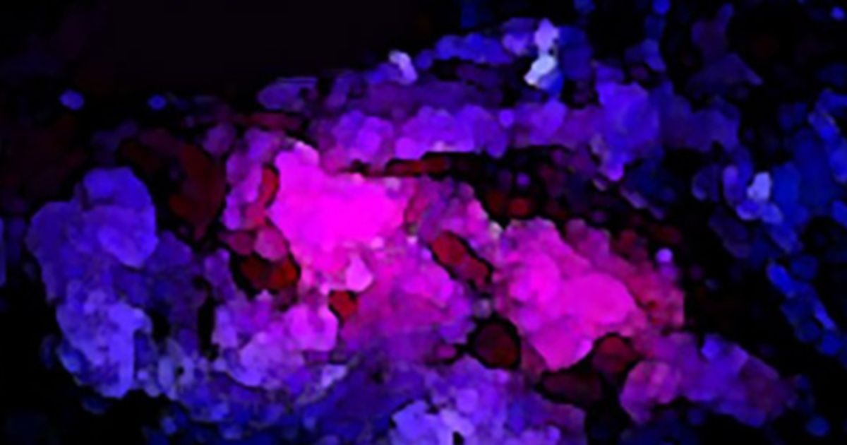 Medexus gets Health Canada nod to market tumor imaging material Gleolan ...