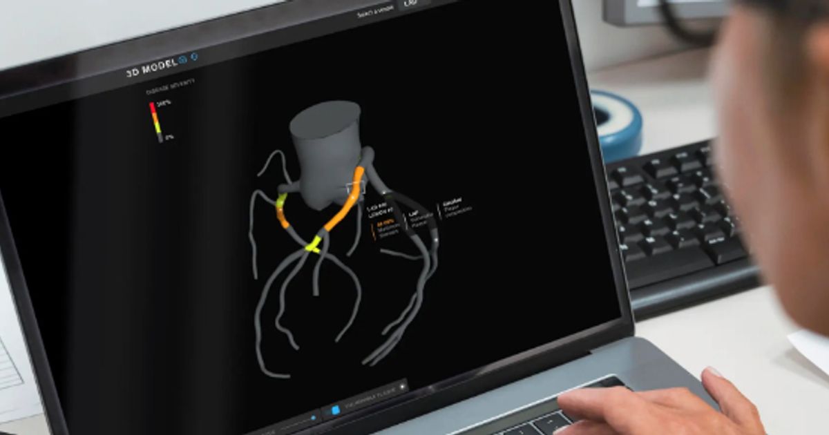 Artrya brings AI-driven heart disease diagnostic tool to the US market ...