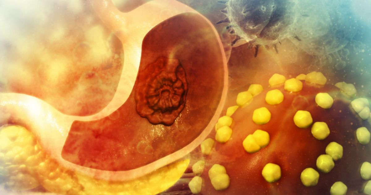 Imugene doses first patient in Phase 2 clinical trial | ASX:IMU, OTC:IUGNF