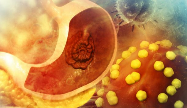 Imugene doses first patient in Phase 2 clinical trial | ASX:IMU, OTC:IUGNF