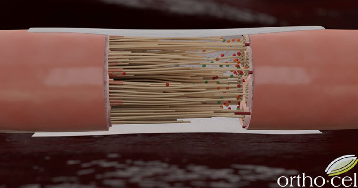 Orthocell surges on receiving Australian regulatory approval for ...