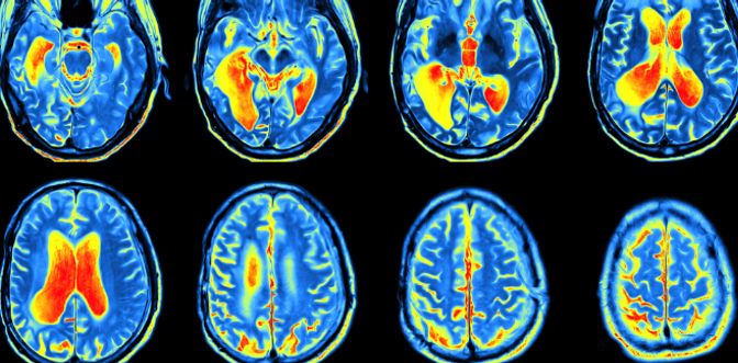 IXICO sees FY23 revenue in line with expectations; boosted by Alzheimer ...