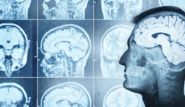 IXICO lands contract orders in Huntington's Disease imaging venture ...