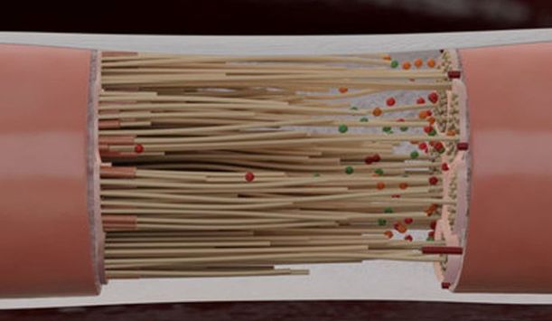 Orthocell kicks off comparator study for nerve repair device Remplir ...