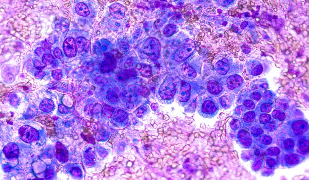 Genprex wins approval to advance Phase 2 expansion of Acclaim-1 trial of REQORSA combined with ...