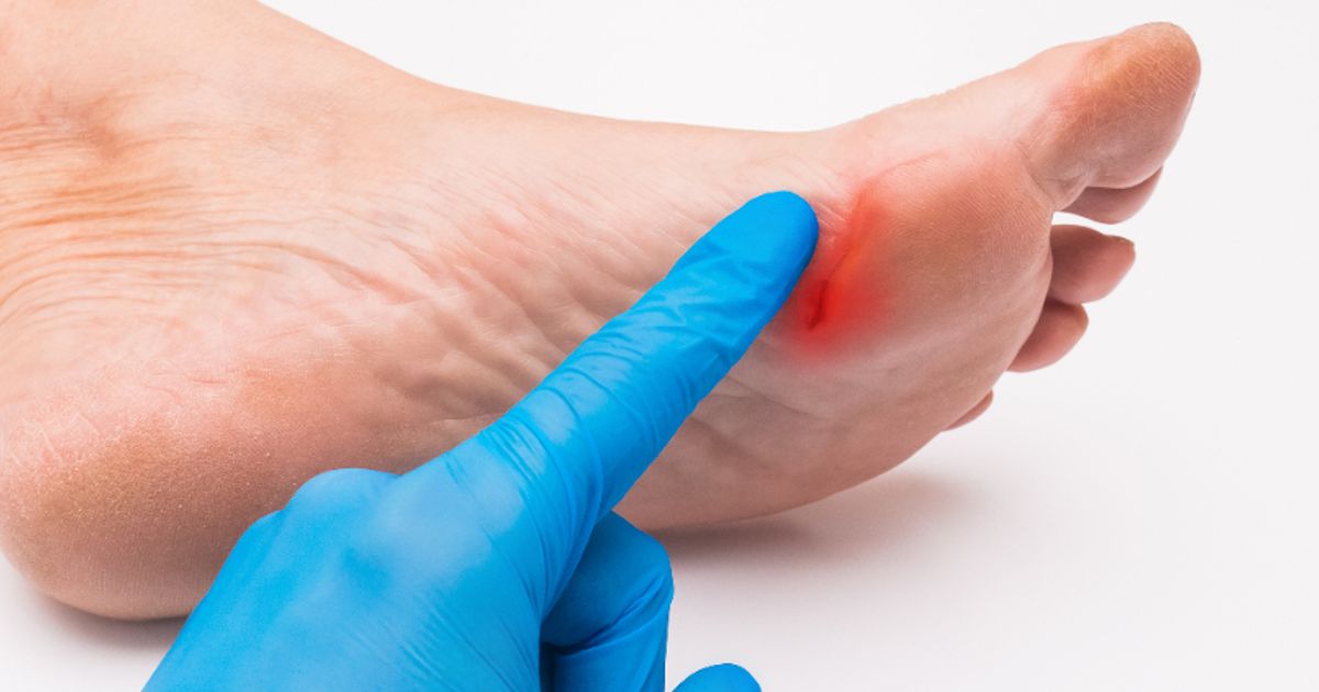 Recce Pharmaceuticals has patients dosed in Phase I/II diabetic foot ...