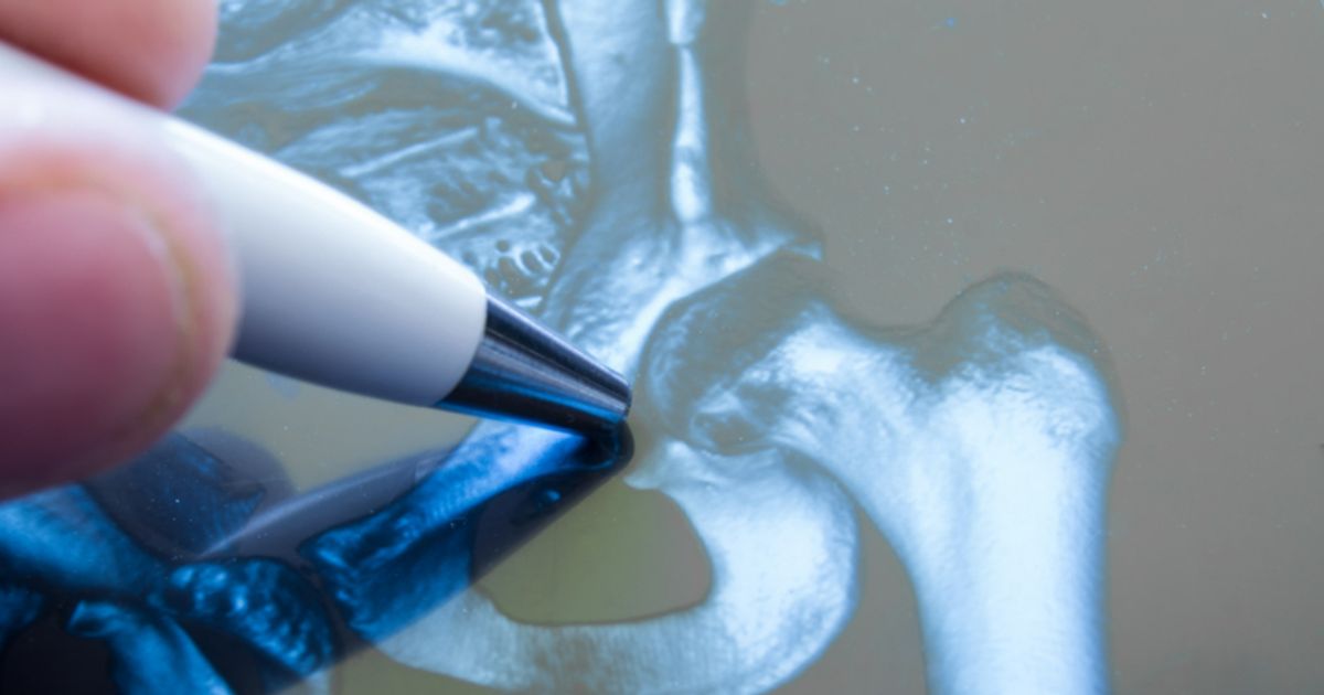 Smith & Nephew should benefit from orthopaedic surgical trends in 2023 ...