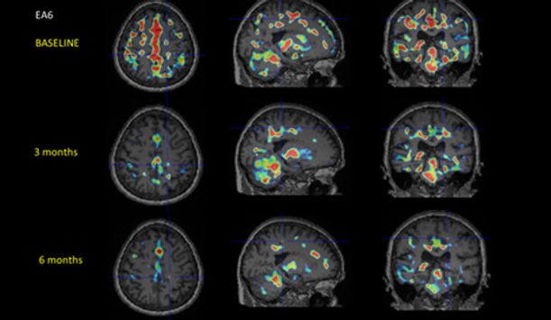 Tiziana Life Sciences reveals positive PET scan results with Foralumab ...