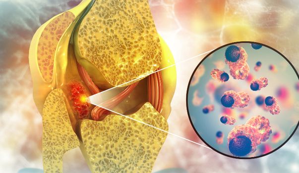 Syntara doses first patient in bone marrow cancer Phase 2 trial ...